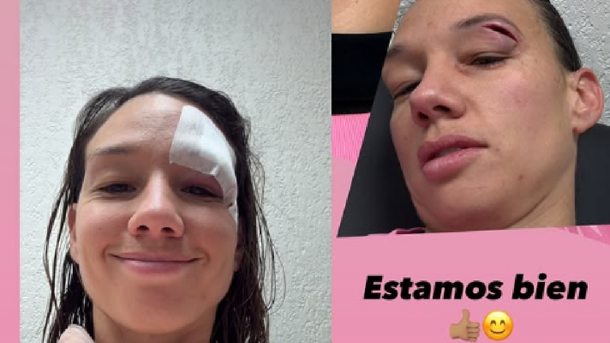 Christiane Endler recibió puntos de sutura en un ojo tras partido ante ...